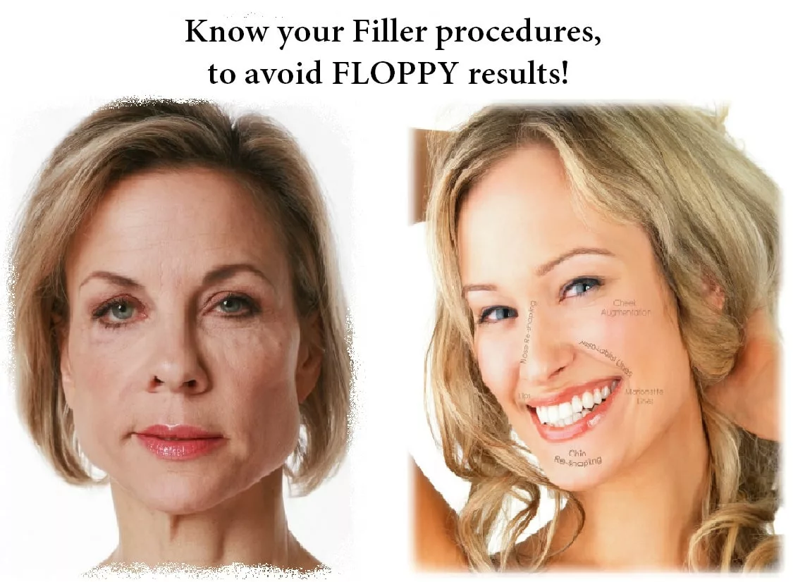 Injectable Fillers - Know your filler procedure(s), to avoid FLOPPY ...